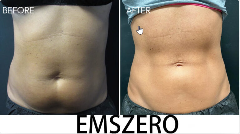 EMSzero™ - Go and Glow Beauty